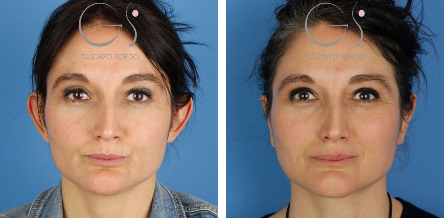 【Protruding Ears: What They Are, How to Correct Them and at What Age】