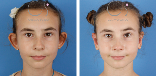 【Protruding Ears: What They Are, How to Correct Them and at What Age】