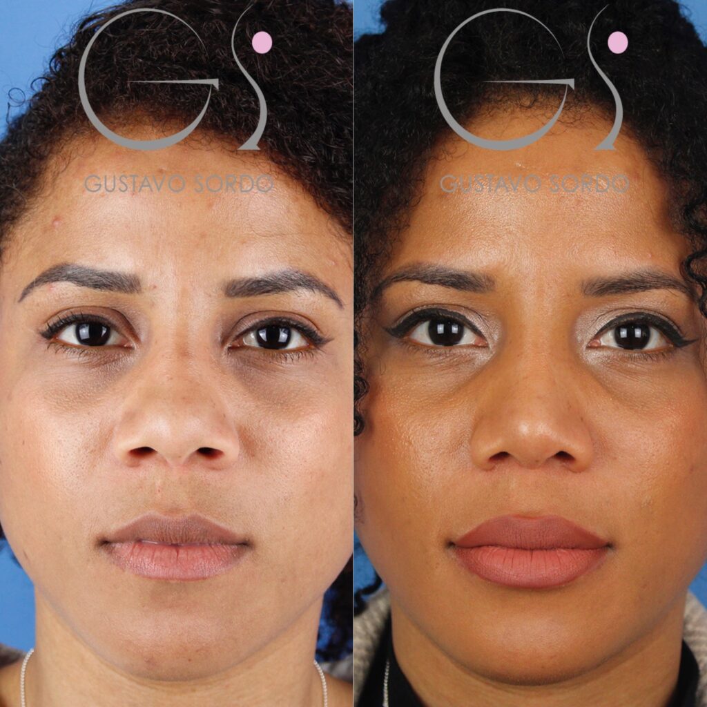 【18 Tipos de Narices: Cuáles son y Diferencias 2025】