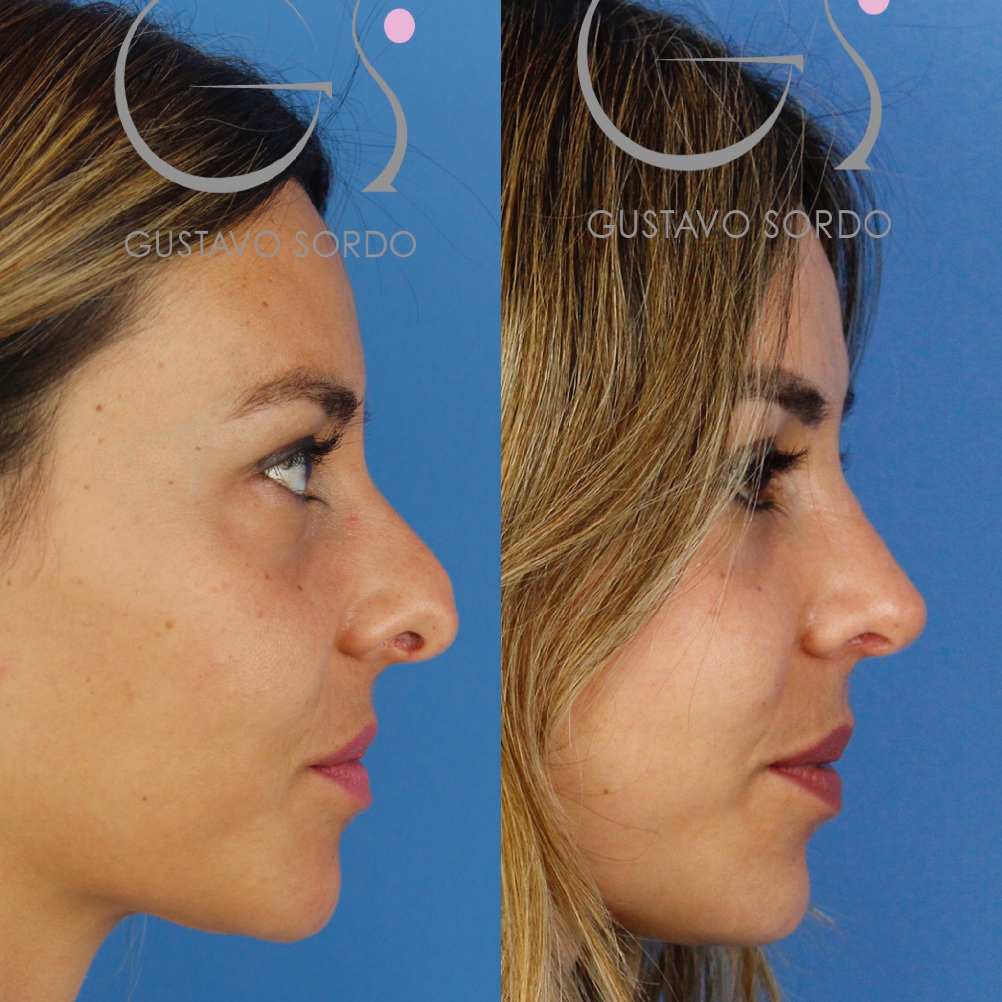 【18 Types of Noses: What They Are and Differences 2025】