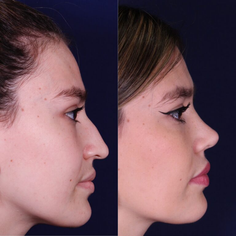 【Upturned Nose: Complete Guide 2026】