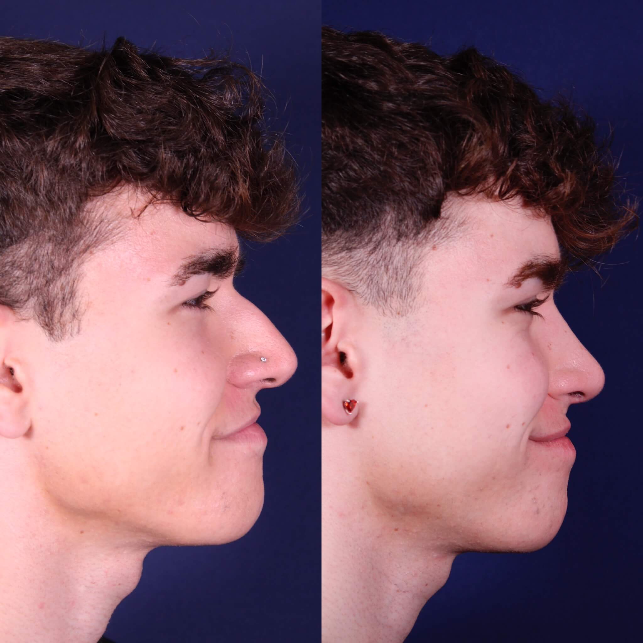 【Rinoplastia en Hombre: Guía Completa 2026】