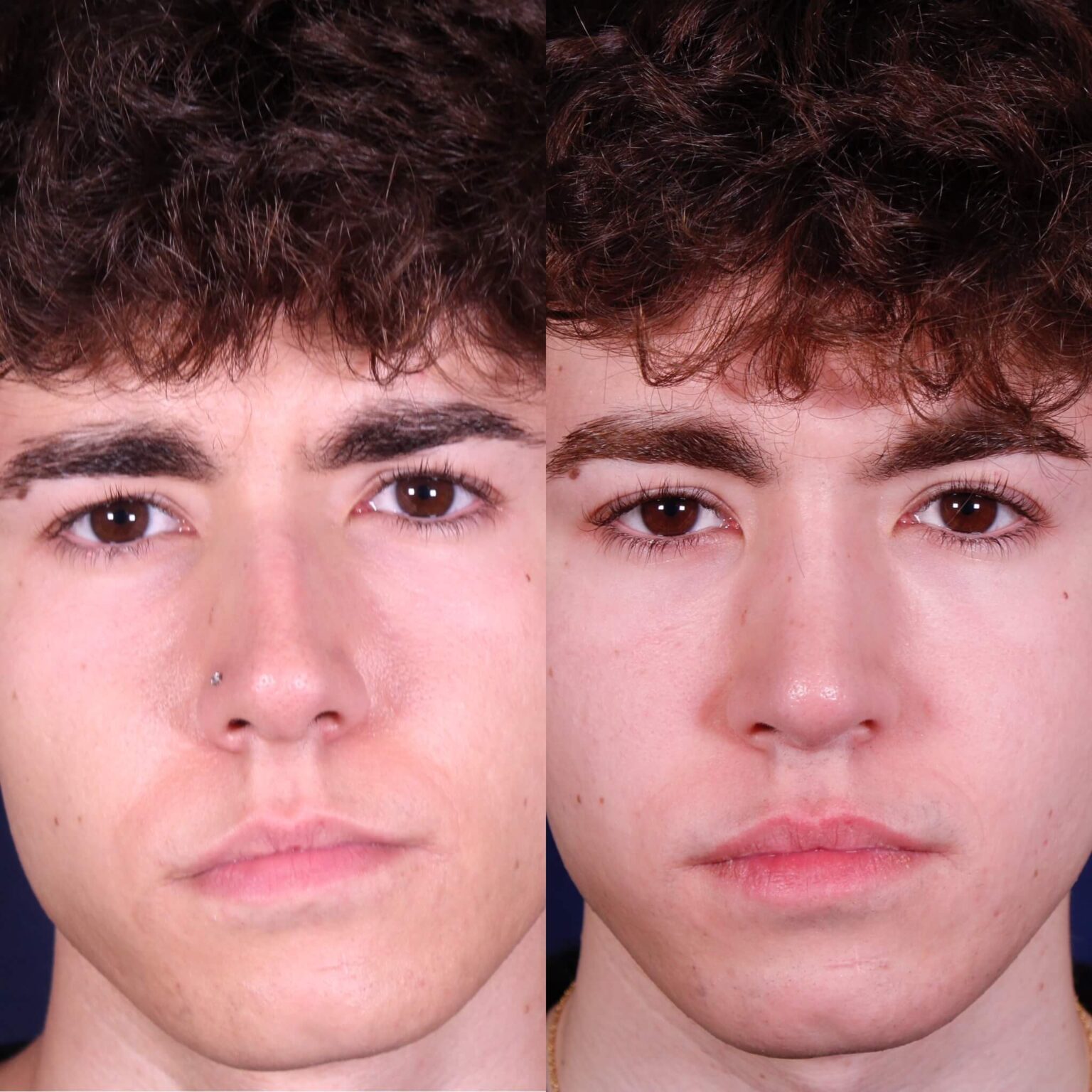 【Rinoplastia en Hombre: Guía Completa 2026】