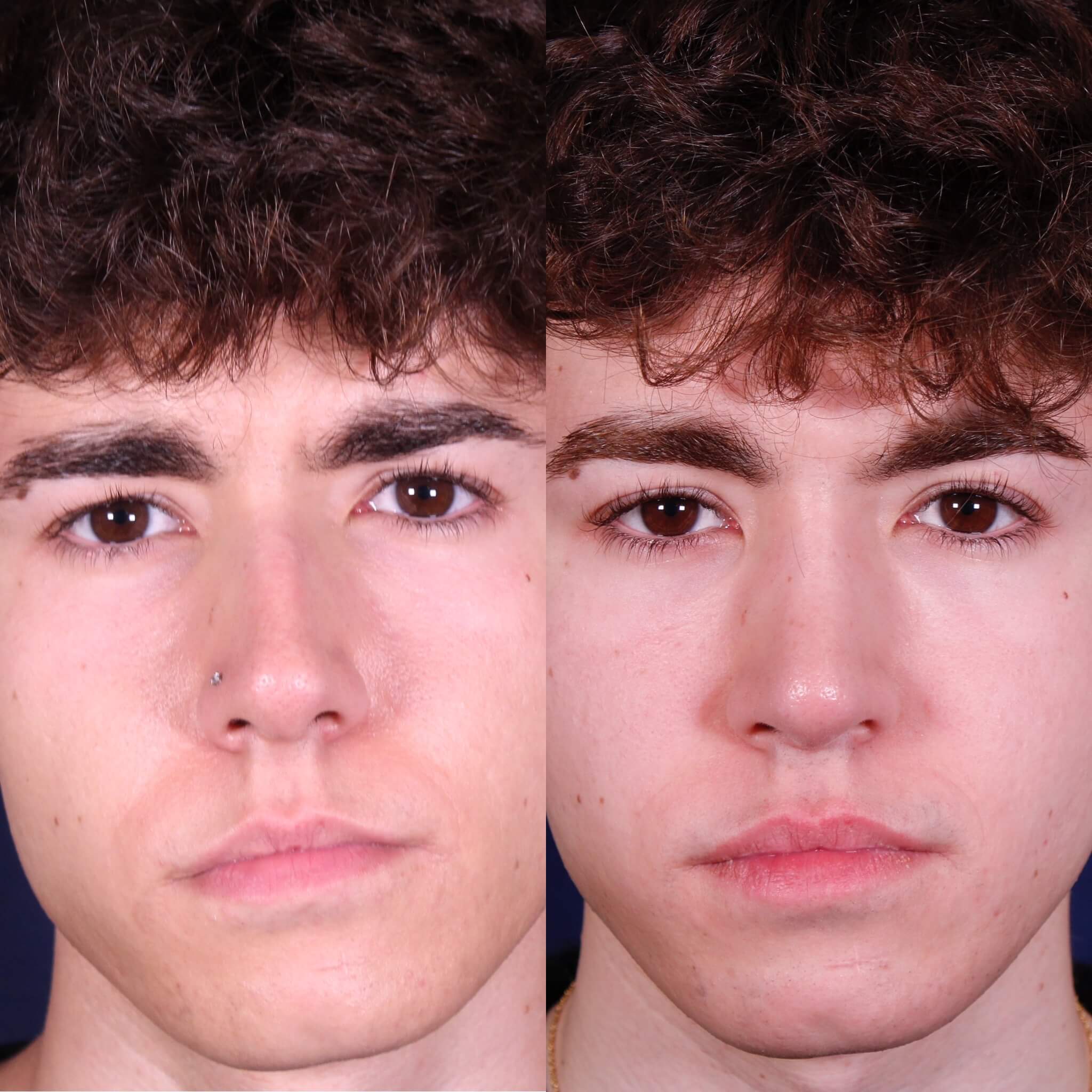 【Rinoplastia en Hombre: Guía Completa 2026】