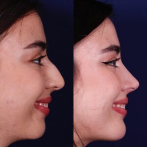 【Septoplasty: What it is, How much it costs and How long it lasts】
