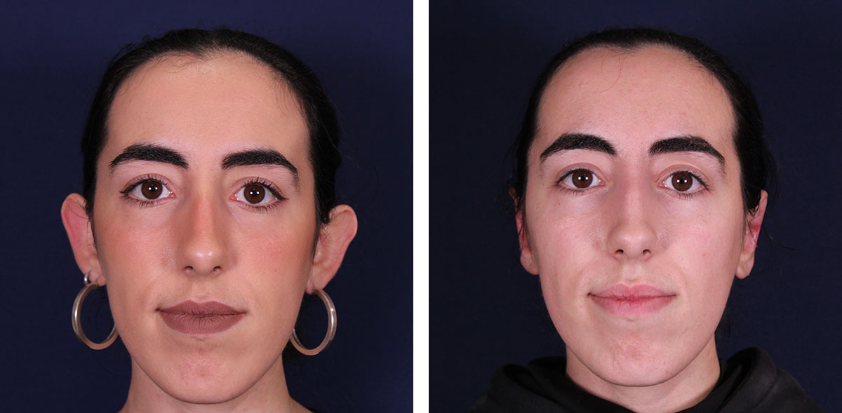 【Antes y Después Otoplastia: +50 Fotos | Casos Reales 2025】
