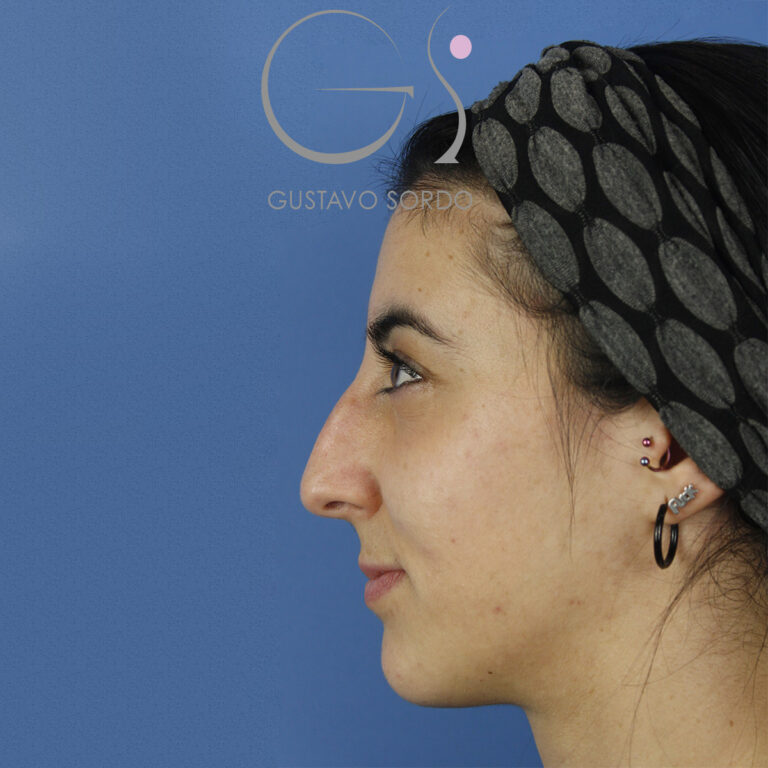 【Roman Nose: What It Is and How to Correct It (2026)】