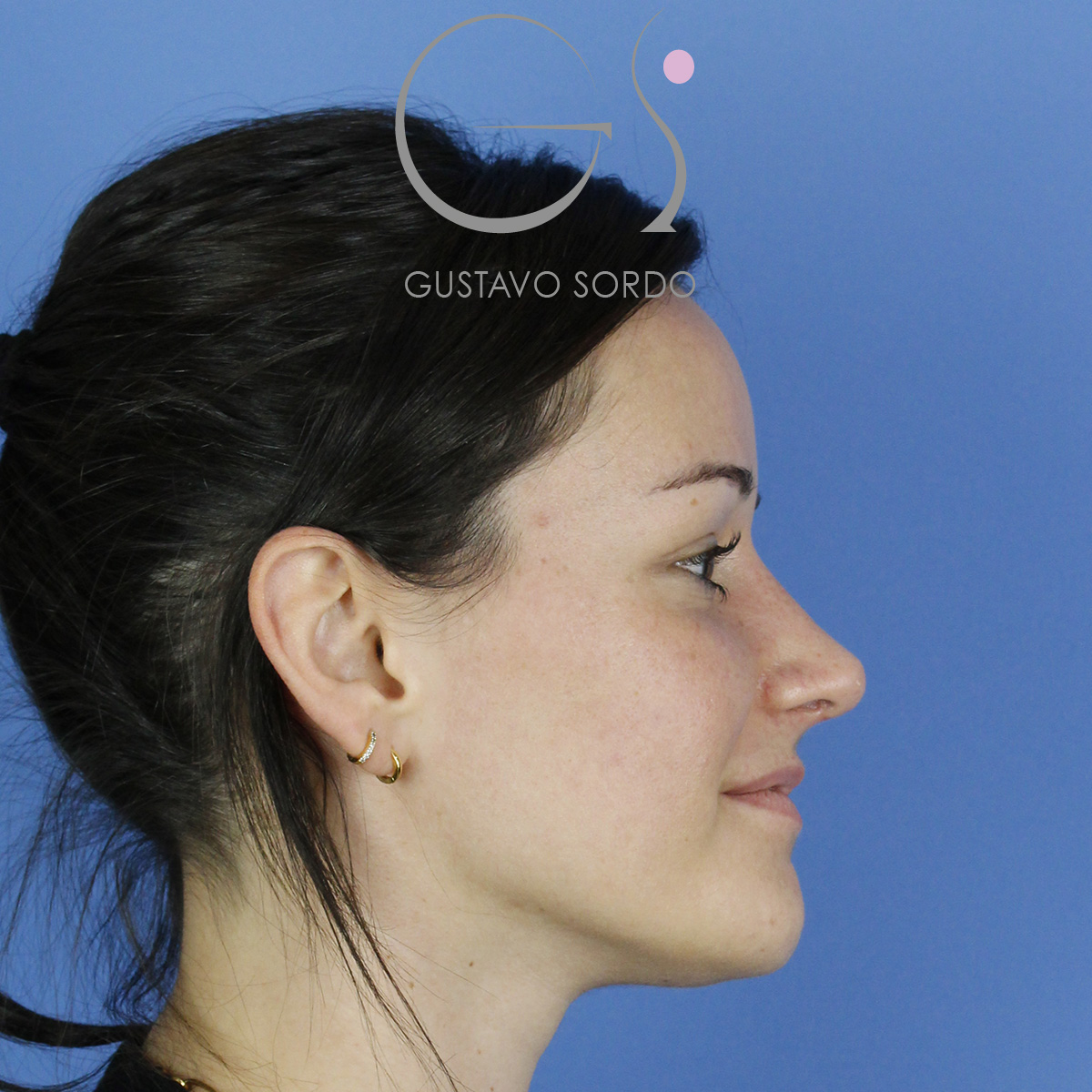 【Aquiline Nose: What It Is, Causes, and How to Correct It (2026)】