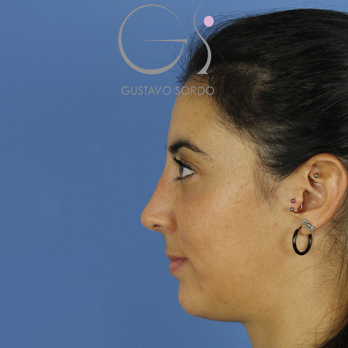 【Roman Nose: What It Is and How to Correct It (2026)】