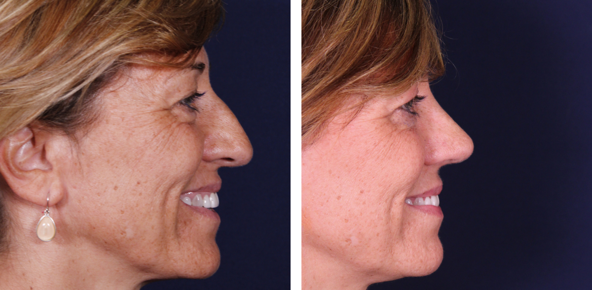 【Septoplasty: What it is, How much it costs and How long it lasts】