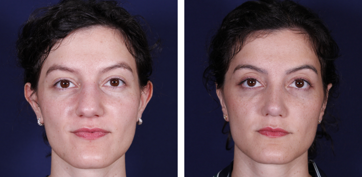 【Protruding Ears: What They Are, How to Correct Them and at What Age】