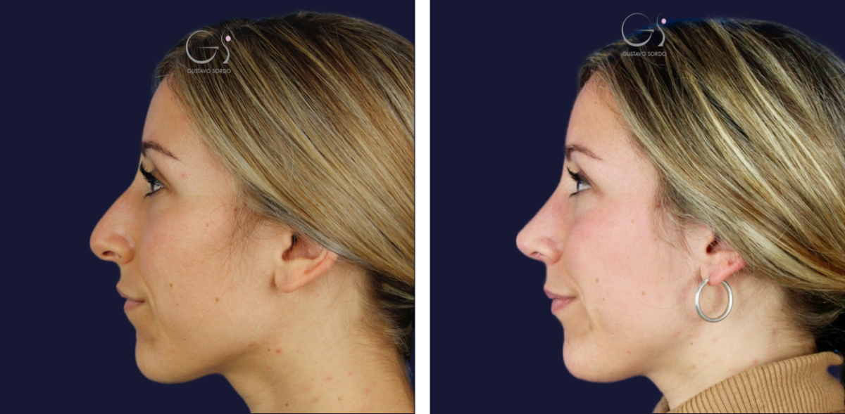 【Rinoplastia Nariz Larga Antes y Después】+50 Casos 2025