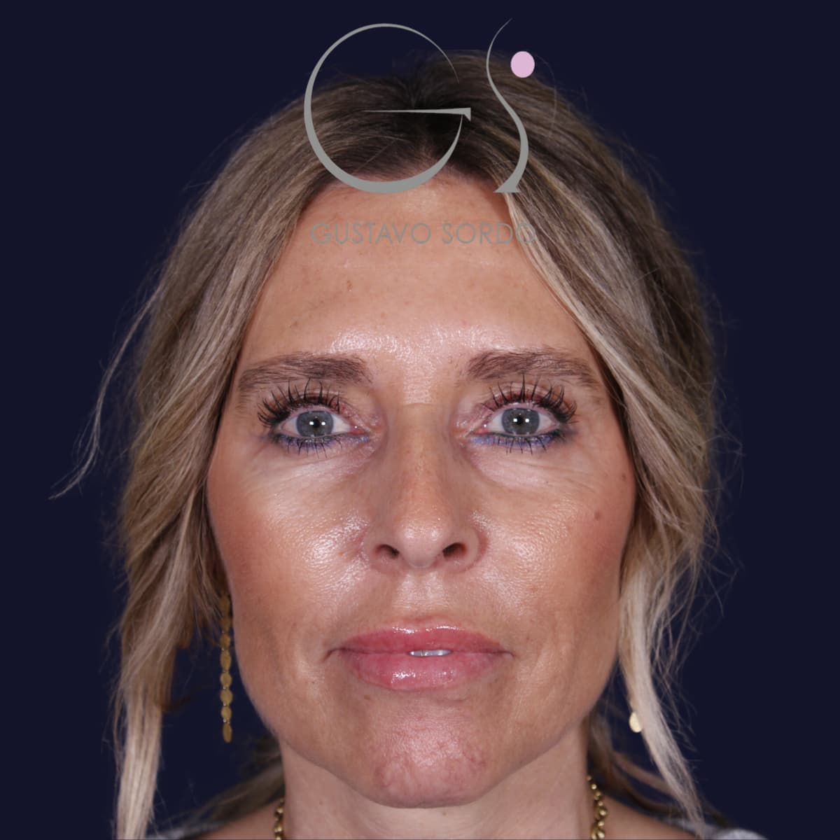 【Deviated Septum Before and After 2025】+50 Cases