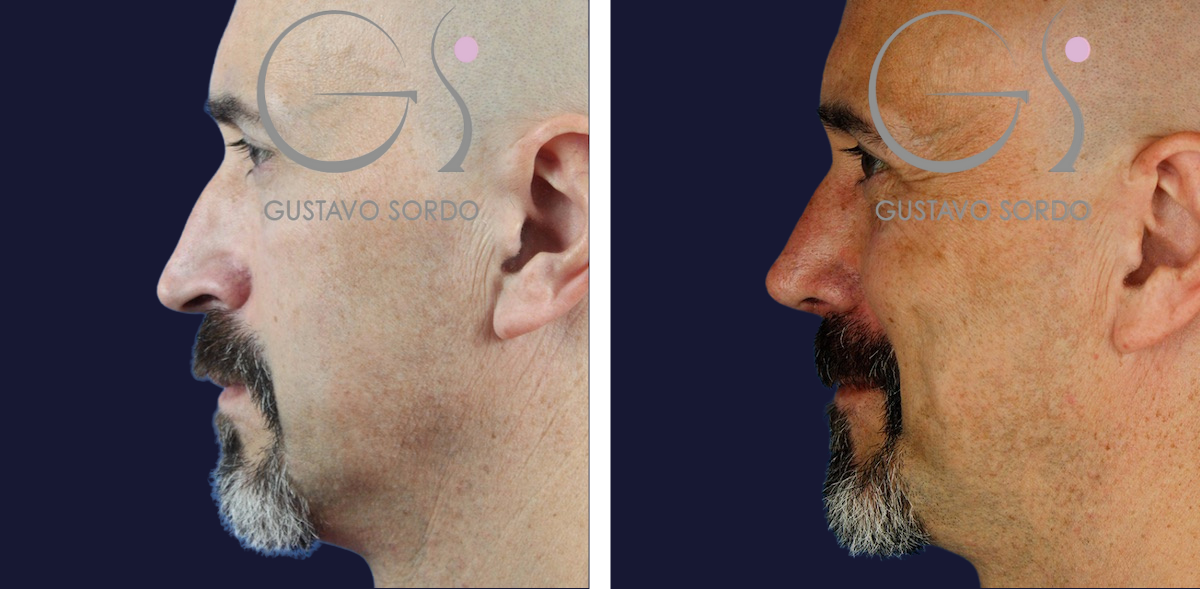 【Rinoplastia Nariz Larga Antes y Después】+50 Casos 2025