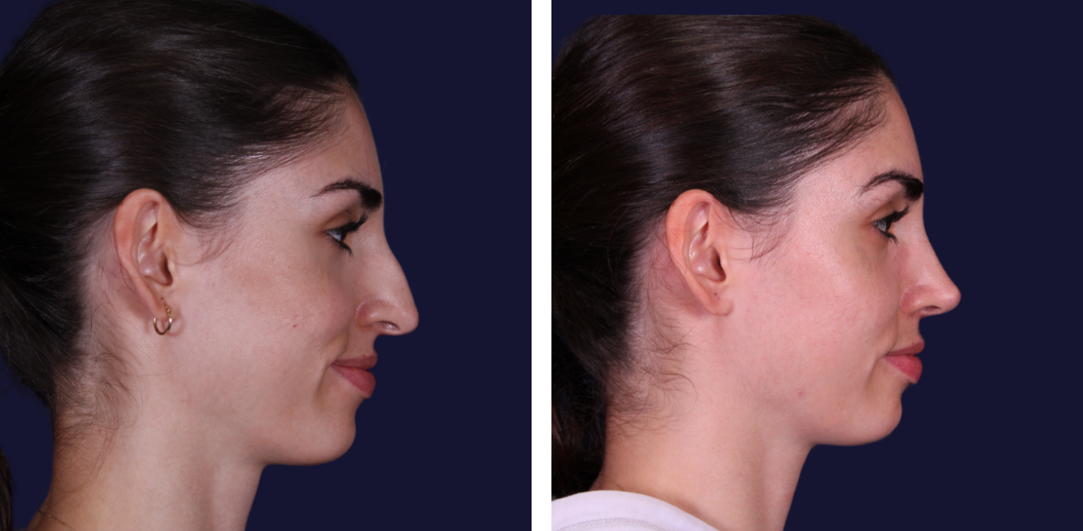 【Nariz Recta Antes y Después Rinoplastia 2026】+100 Casos