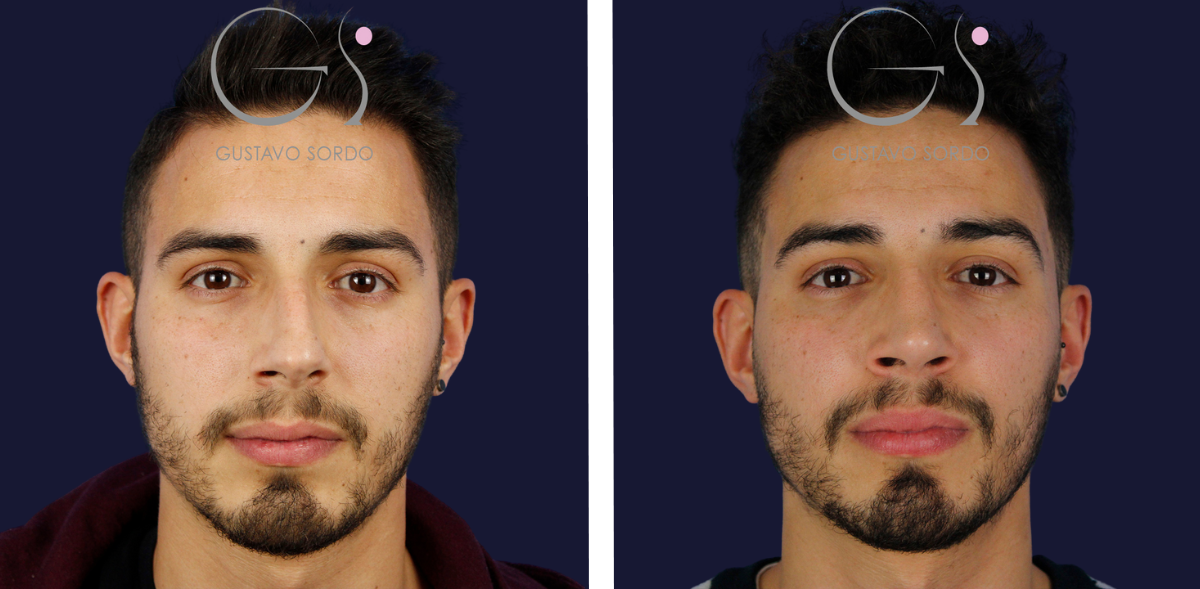 【Tabique Nasal Desviado Antes y Después 2025】+50 Casos
