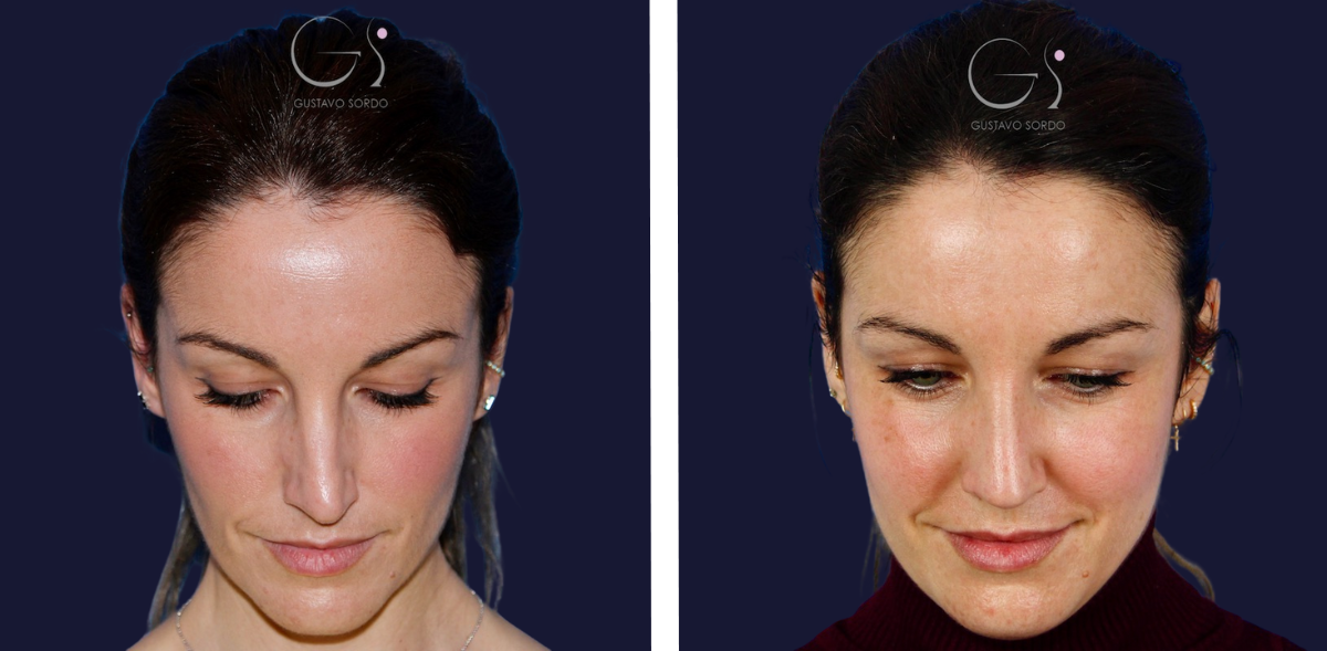 【Deviated Septum Before and After 2025】+50 Cases