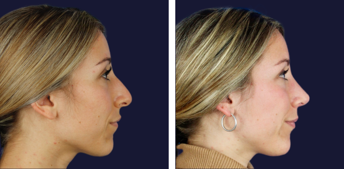 【Long Nose Rhinoplasty Before and After】+50 Cases 2026