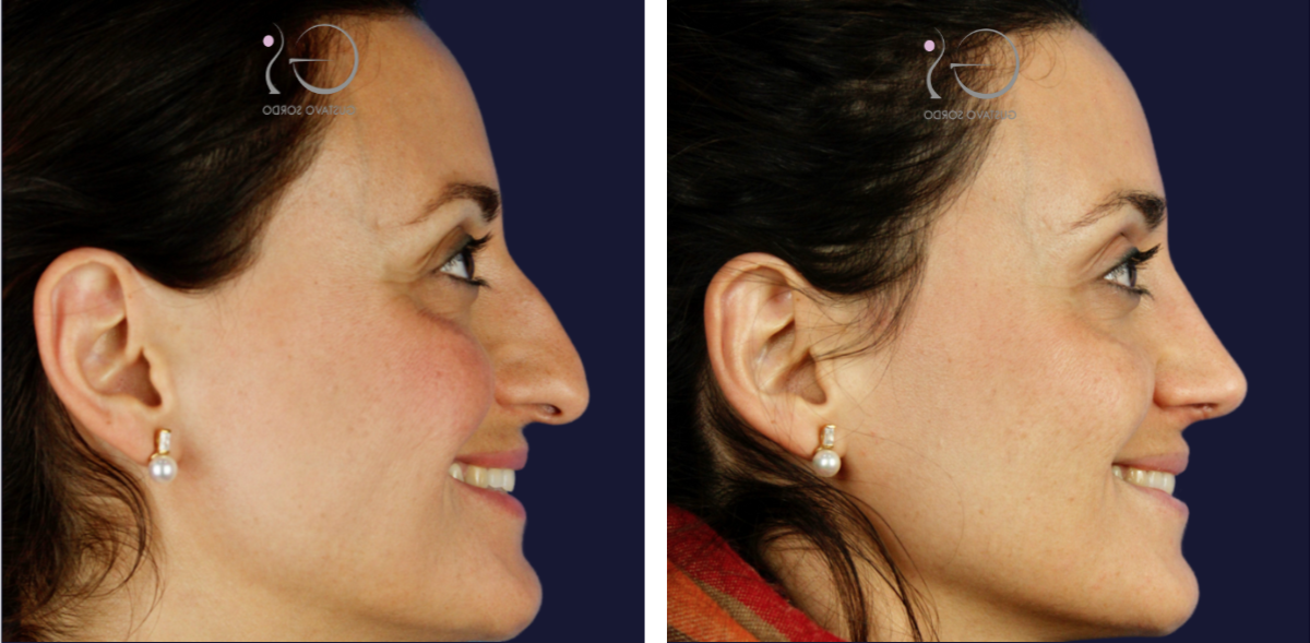 【Long Nose Rhinoplasty Before and After】+50 Cases 2026