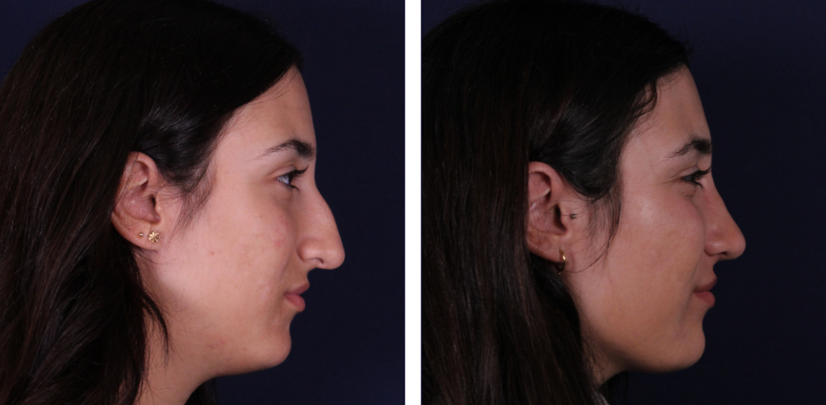 【Long Nose Rhinoplasty Before and After】+50 Cases 2026