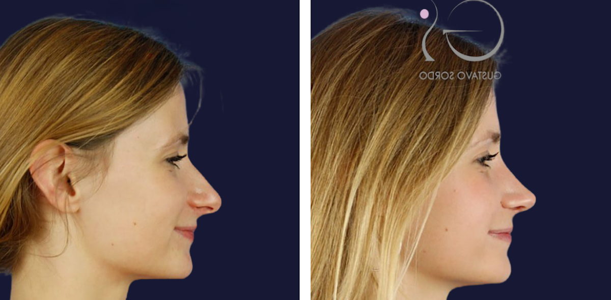 【Rhinoplasty Before and After Bulbous Nose 2026】+50 Cases