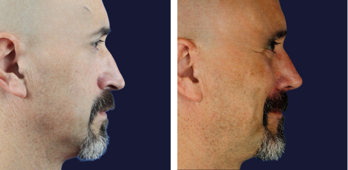 【Long Nose Rhinoplasty Before and After】+50 Cases 2026