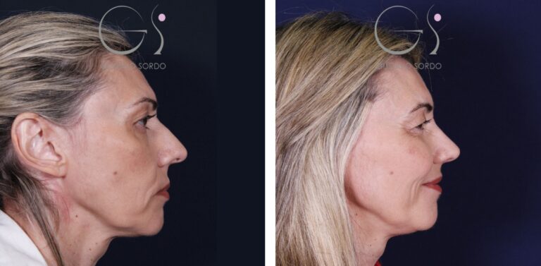 【Long Nose Rhinoplasty Before and After】+50 Cases 2026