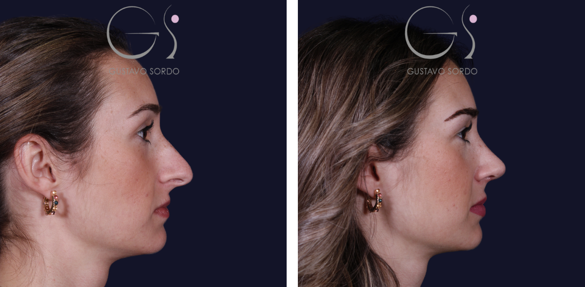 【Long Nose Rhinoplasty Before and After】+50 Cases 2026