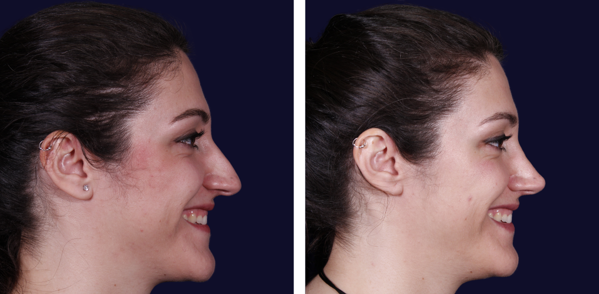 【Droopy Tip Rhinoplasty Before and After】+100 Cases 2026